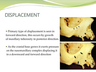 Development of maxilla | PPTX