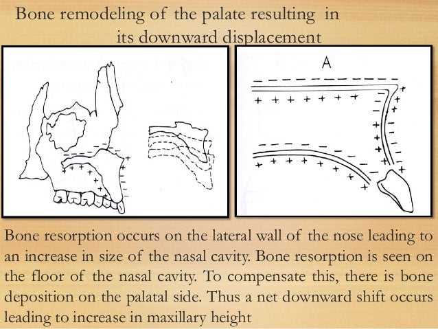 Development of maxilla and palate