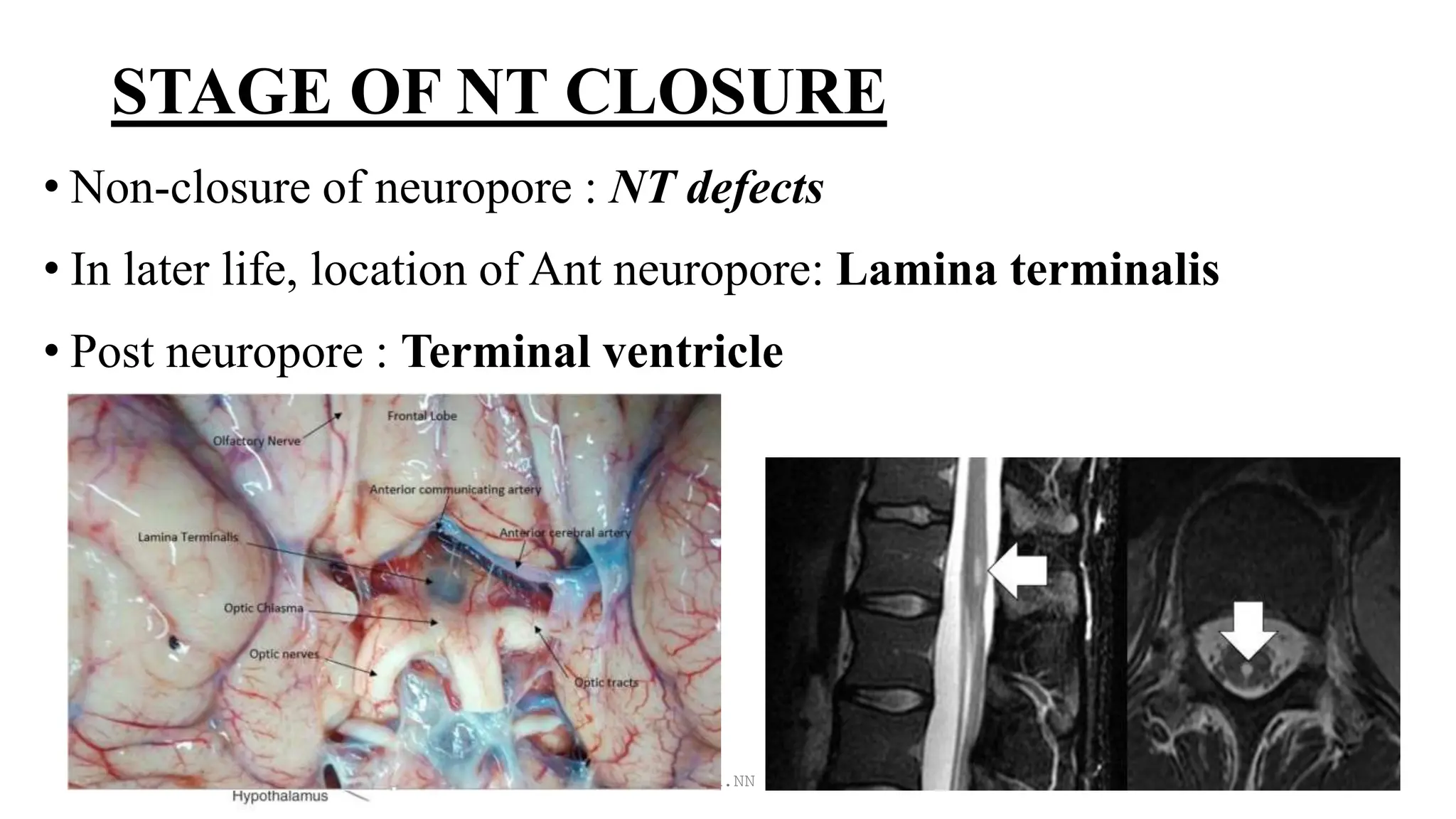 DEVELOPMENT OF NEURAL TUBE & SPINAL CORD.pptx
