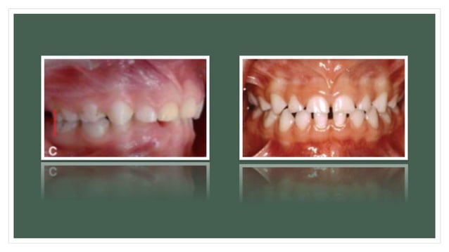 Development of normal occlusion | PPTX