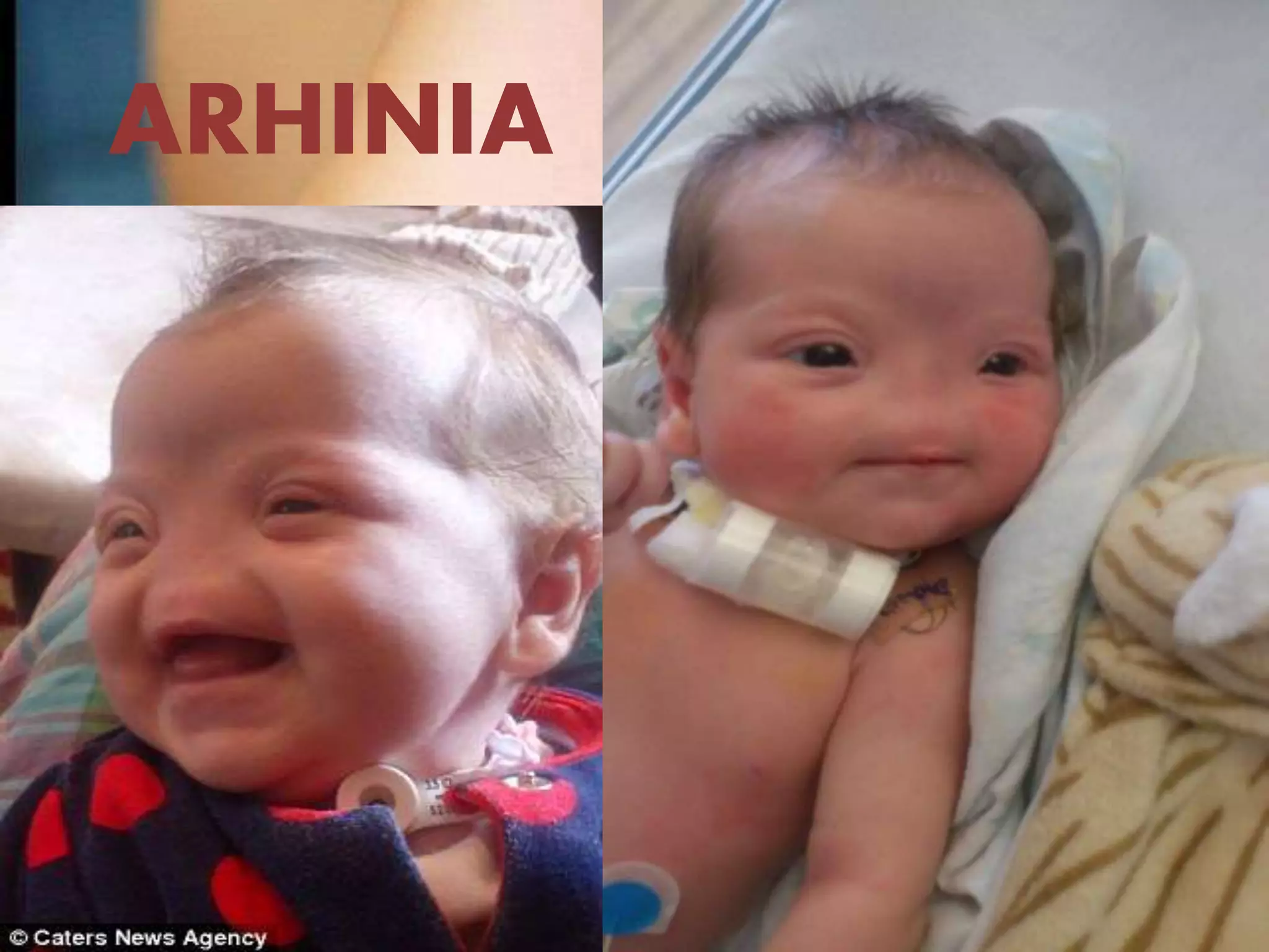 Development of nose by av sharma | PPTX