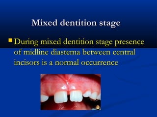 Development of occlusion | PPT