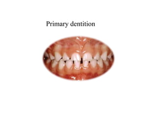 Development of Occlusion from infancy to adolescence. PPT | PPTX