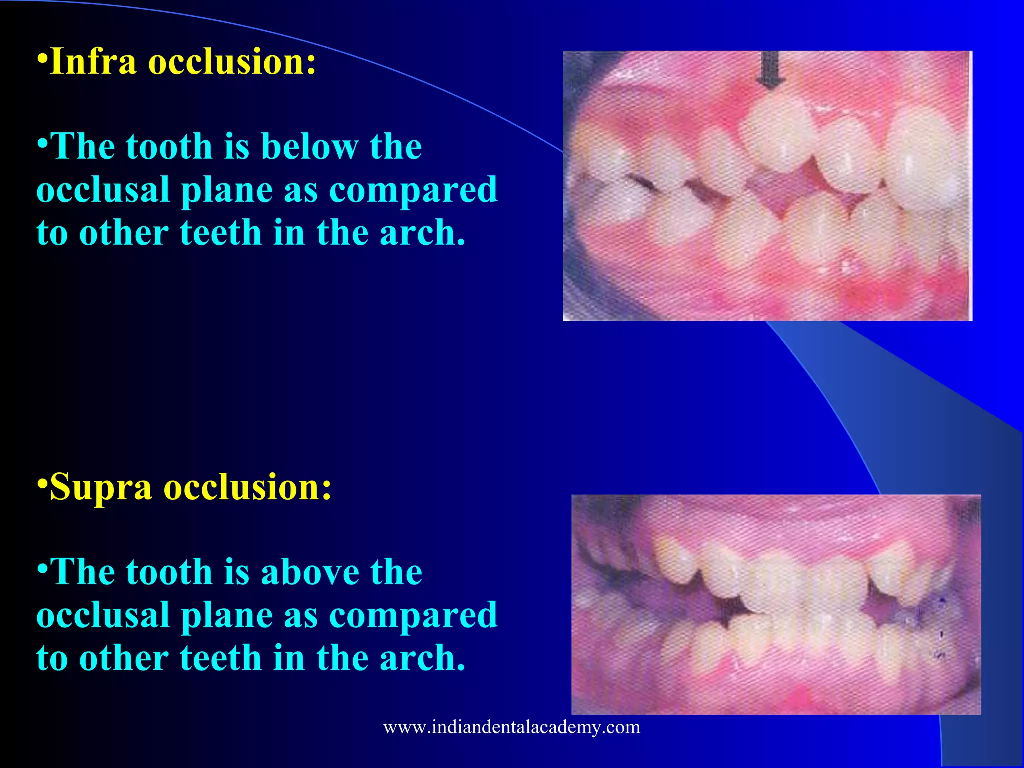 Development of occlusion | PPT