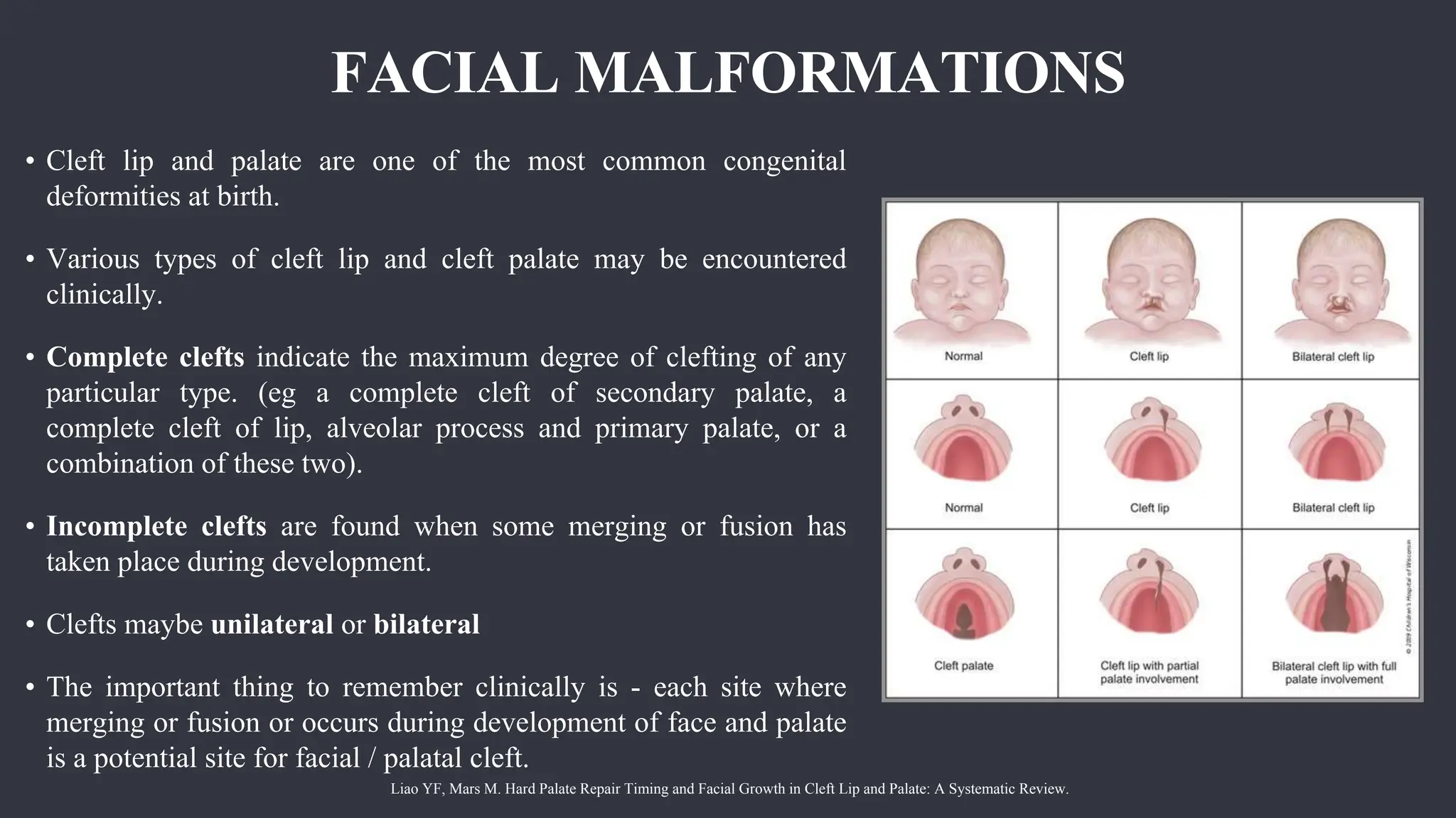Development of Palate and its Anamolies.pptx