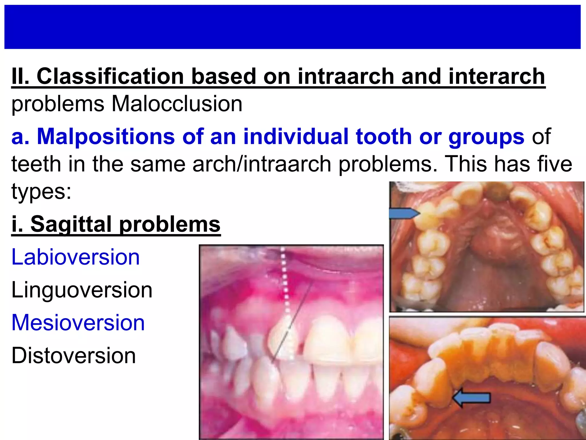 classifcation of malocclusion | PPTX