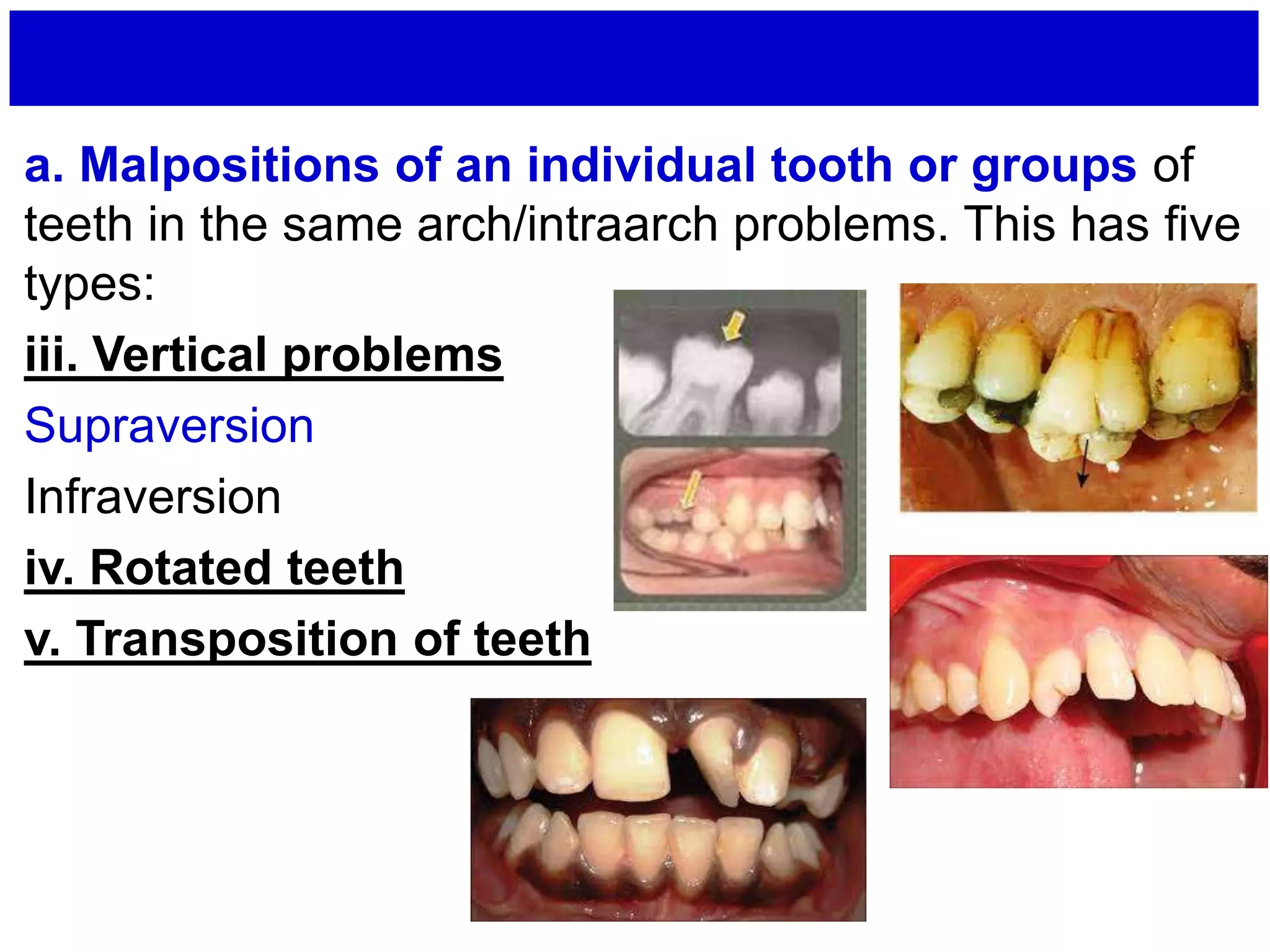 classifcation of malocclusion | PPTX