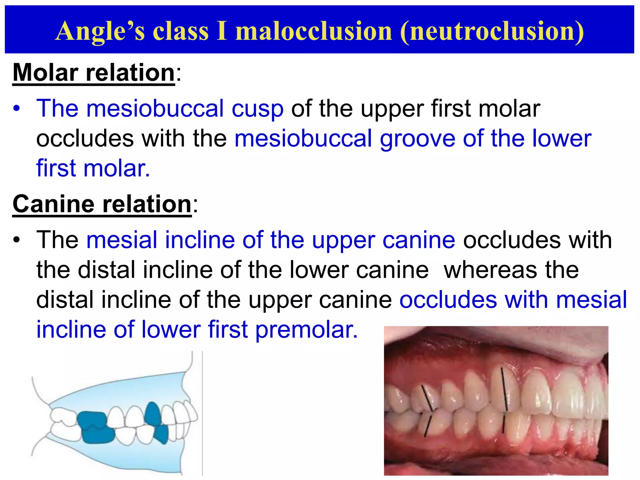 classifcation of malocclusion | PPTX