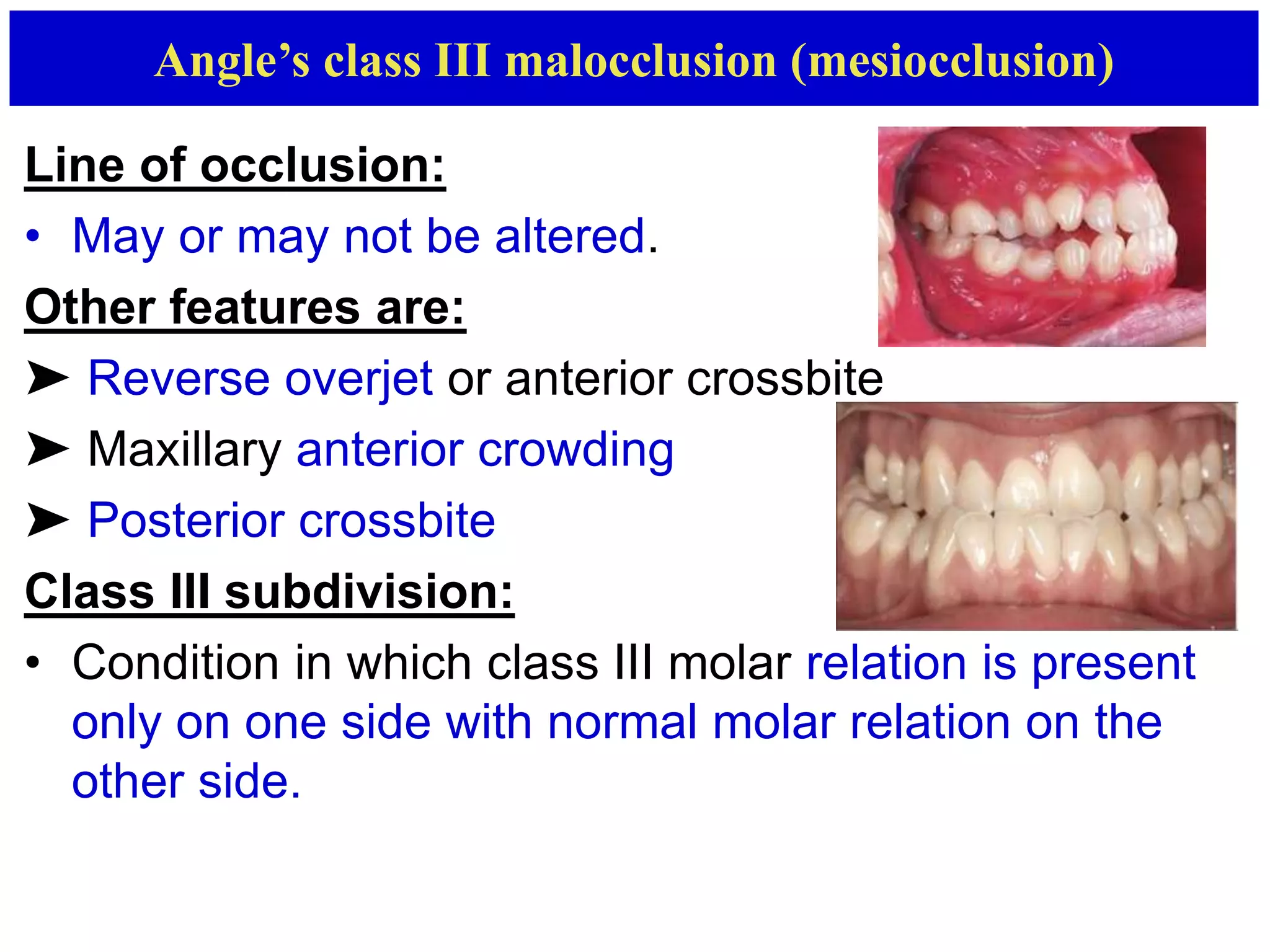 classifcation of malocclusion | PPTX