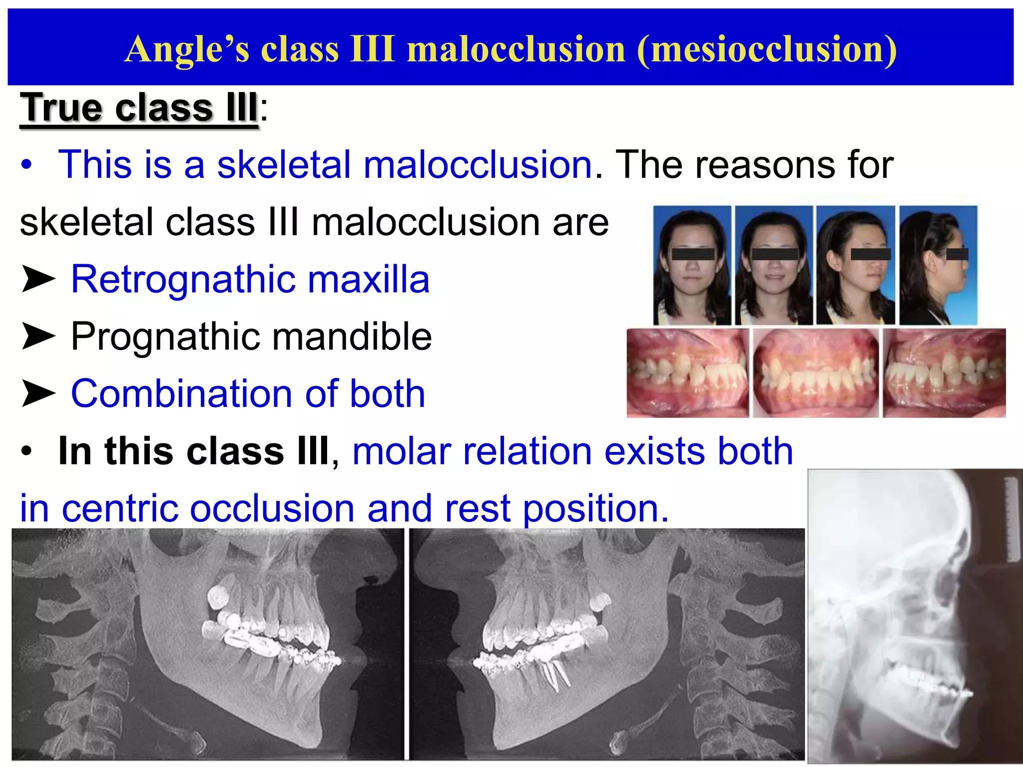classifcation of malocclusion | PPTX