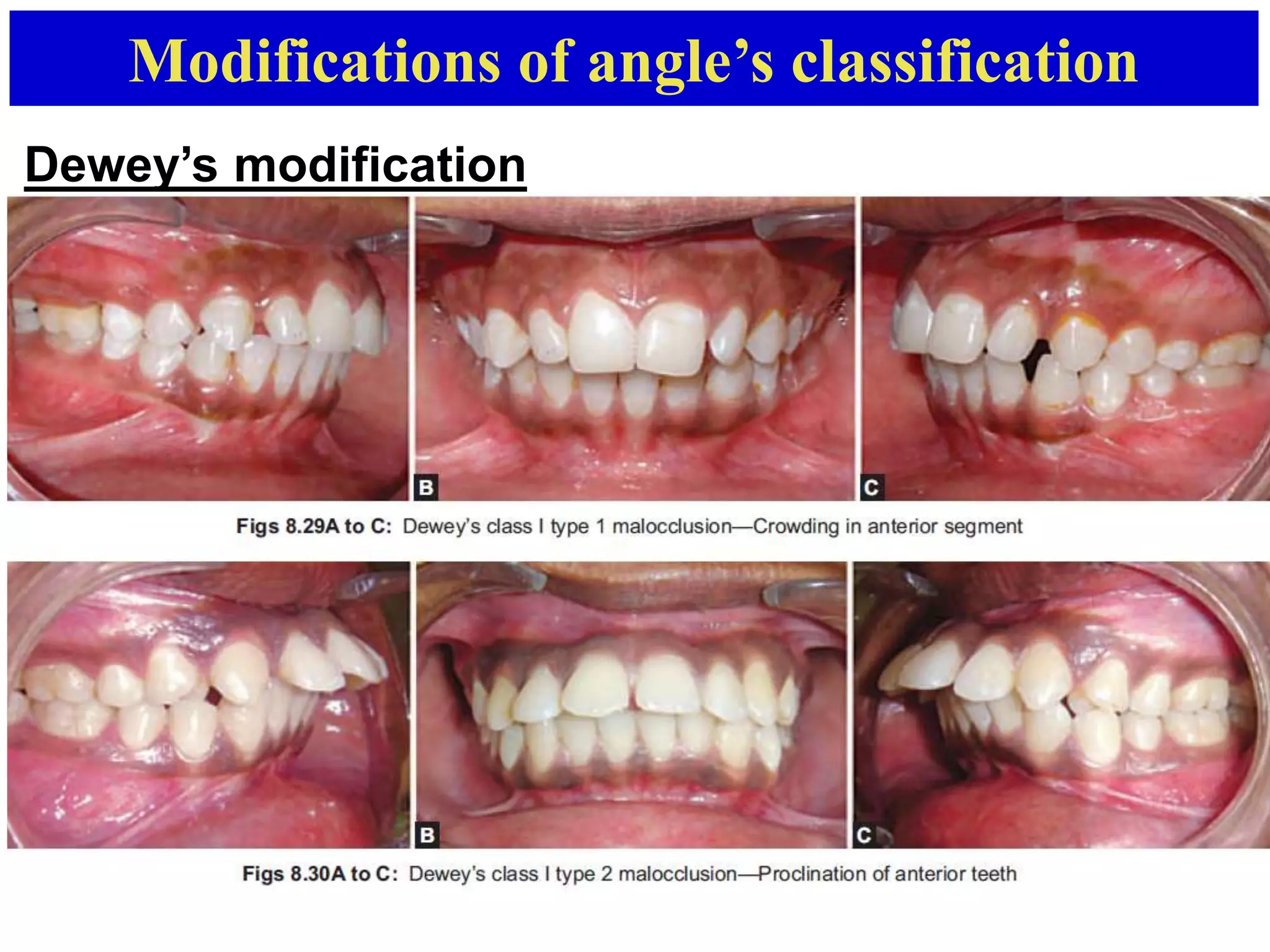 classifcation of malocclusion | PPTX