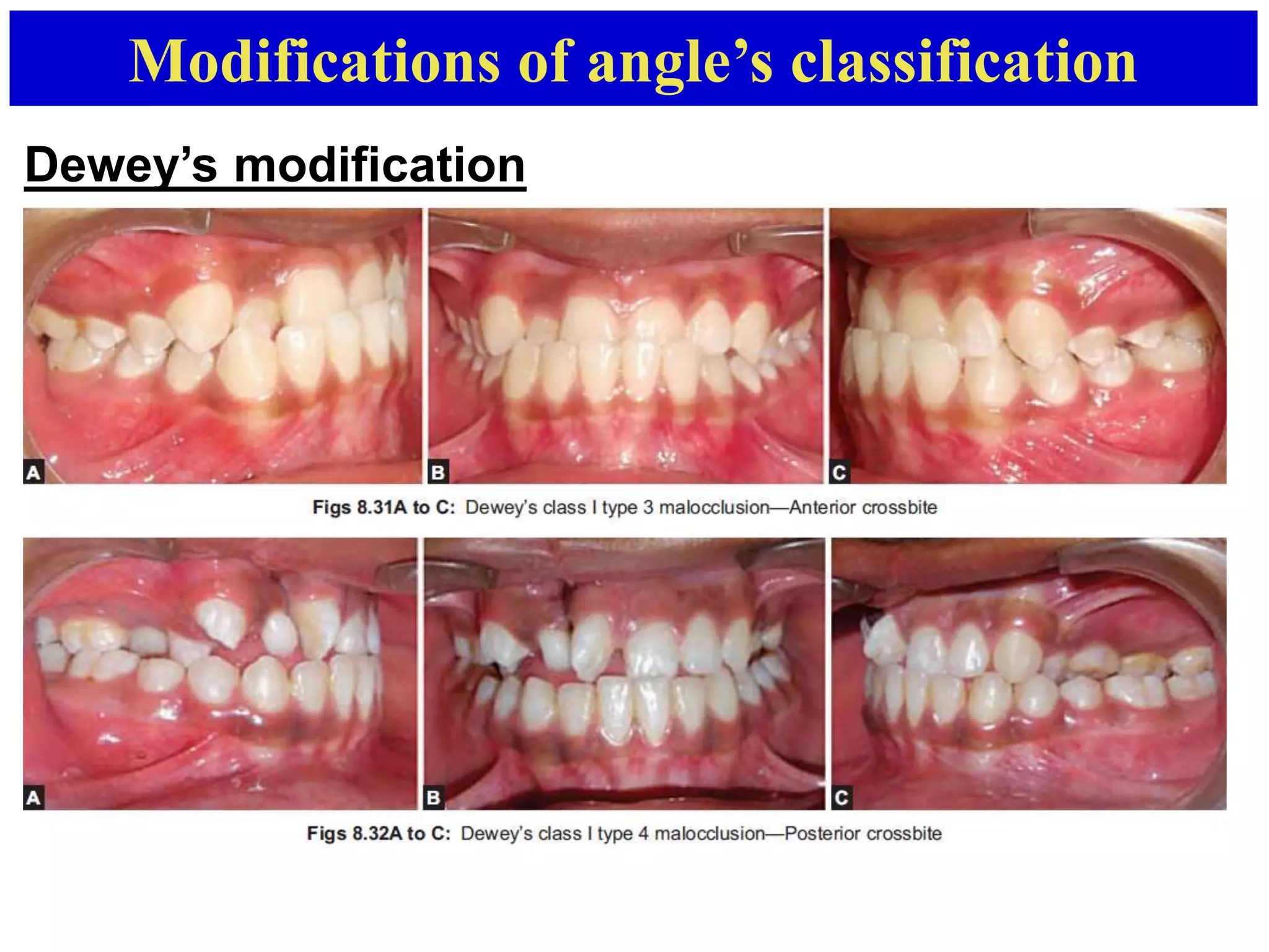 classifcation of malocclusion | PPTX
