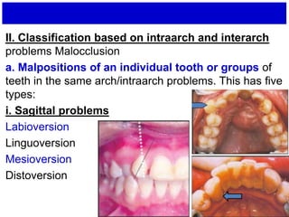 classifcation of malocclusion | PPT