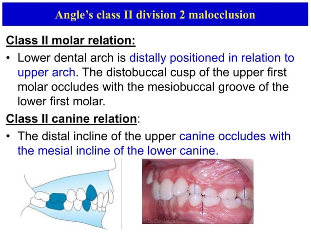 classifcation of malocclusion | PPTX | Dental Health | Diseases and ...