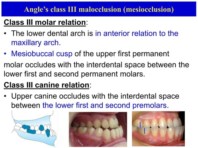 classifcation of malocclusion | PPT