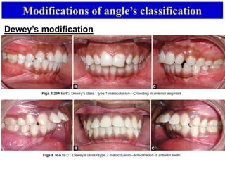 classifcation of malocclusion | PPT