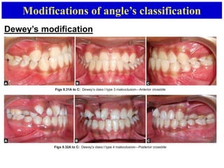 classifcation of malocclusion | PPT
