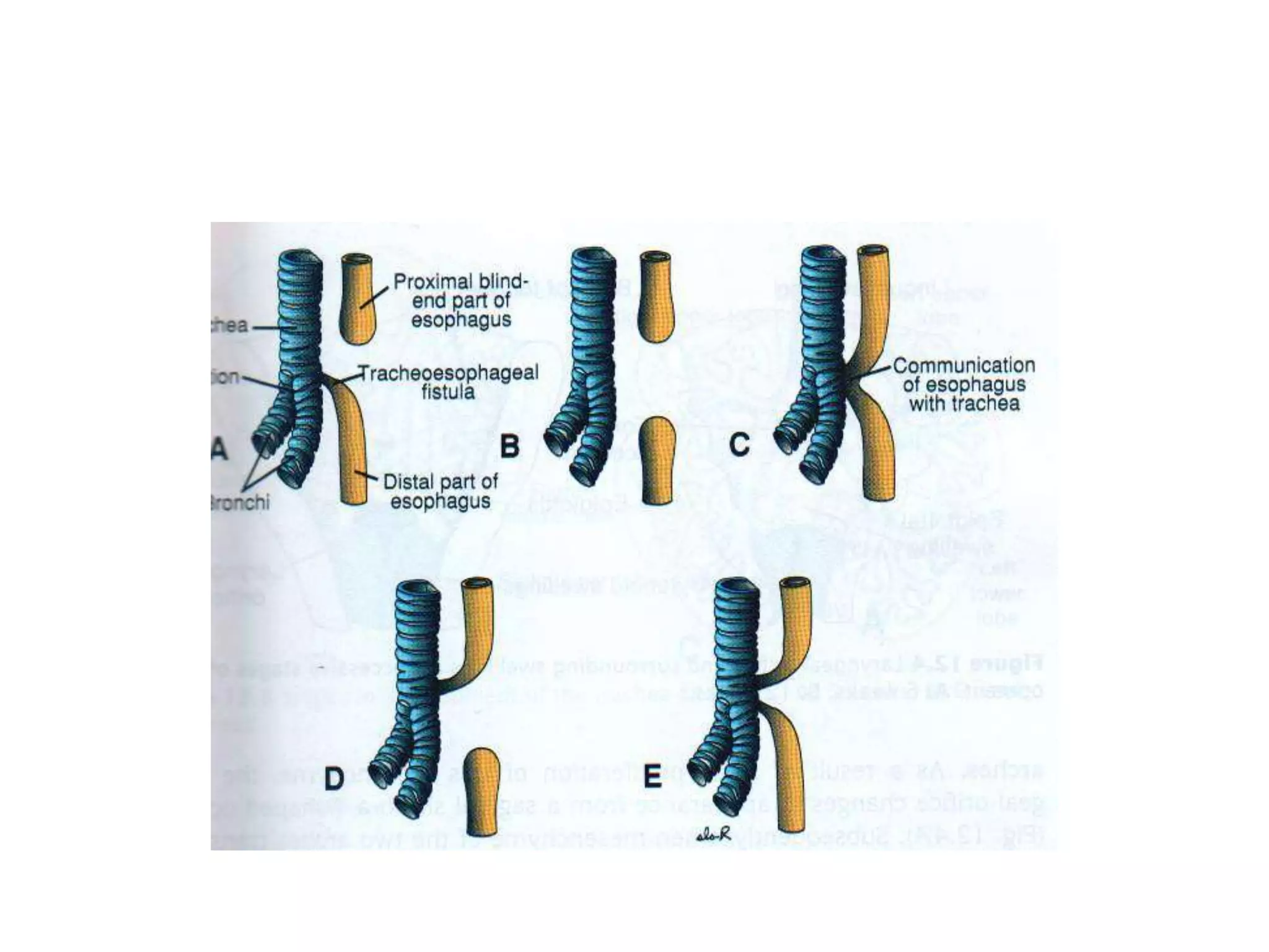 Development of Respiratory System ii trachea, bronchial tree & lung | PPTX