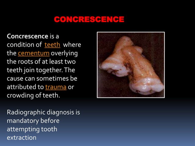 Development of teeth and developmental defects | PPTX