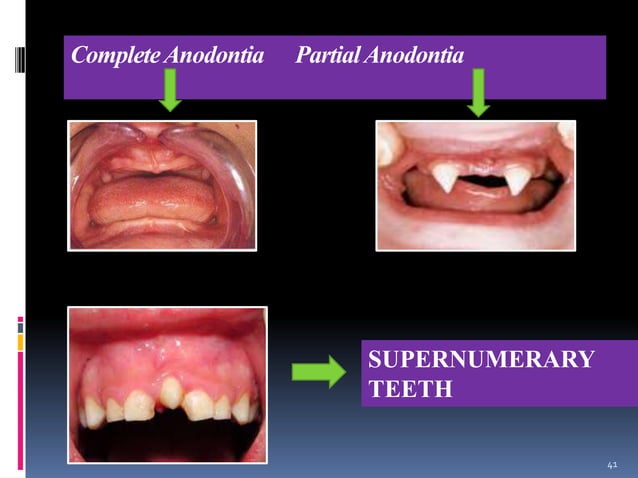 Development of teeth and developmental defects | PPTX