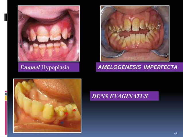 Development of teeth and developmental defects | PPTX