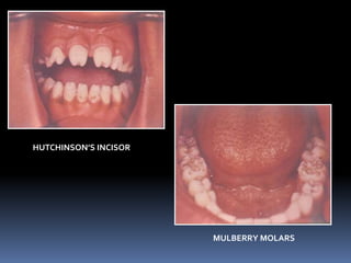 Hutchinson Teeth Mulberry Molars
