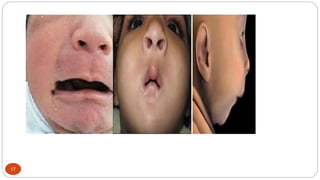 development of the face and palate.pptx