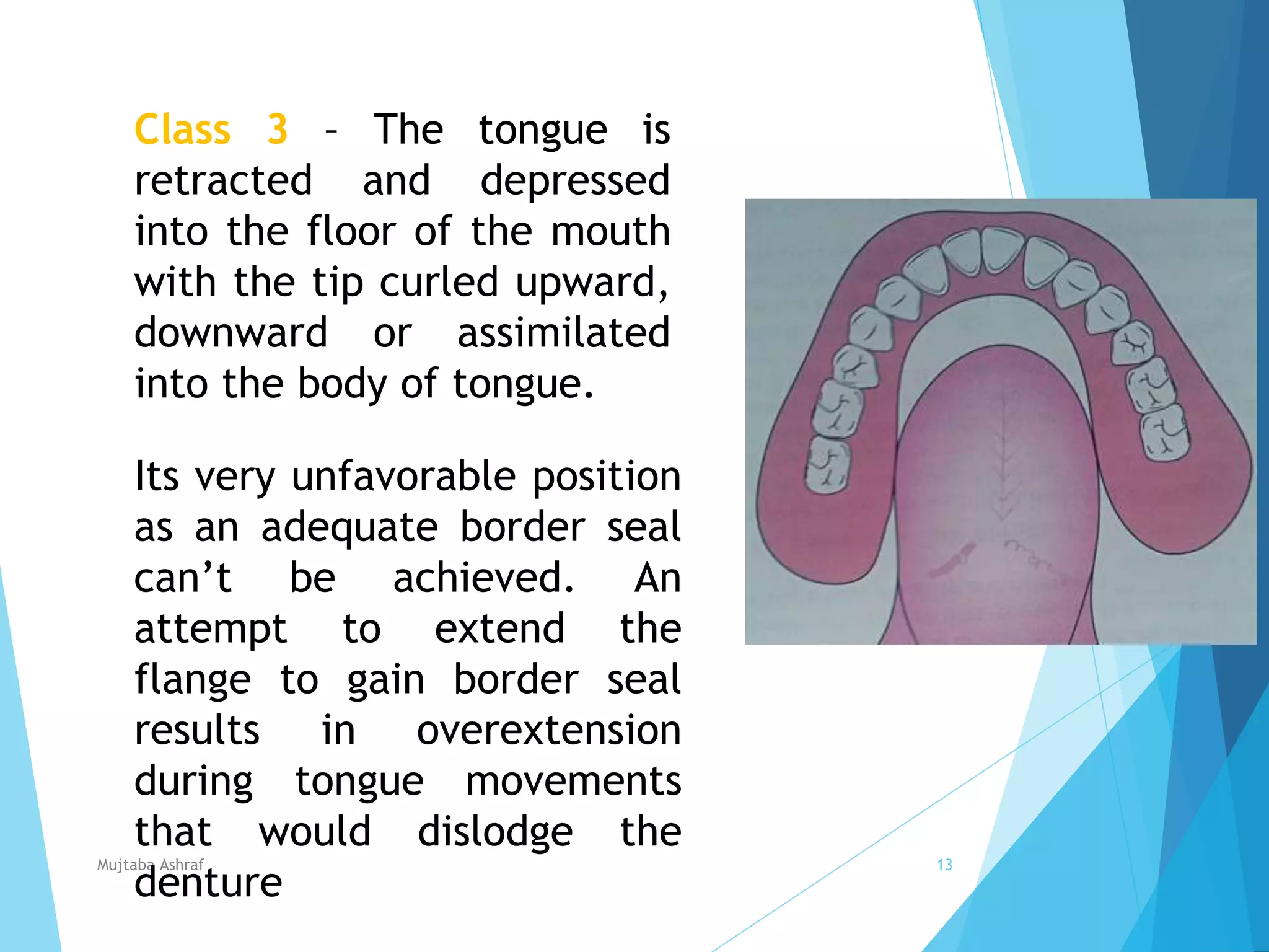 Development of tongue, Speech & Prosthodontic consideration | PPTX
