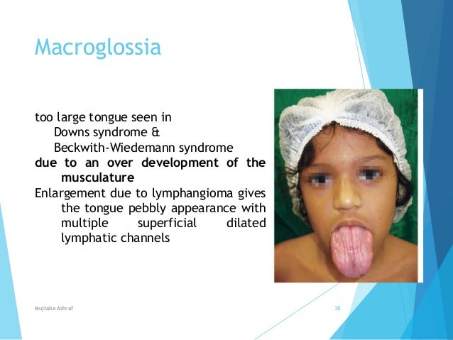 Development of tongue, Speech & Prosthodontic consideration