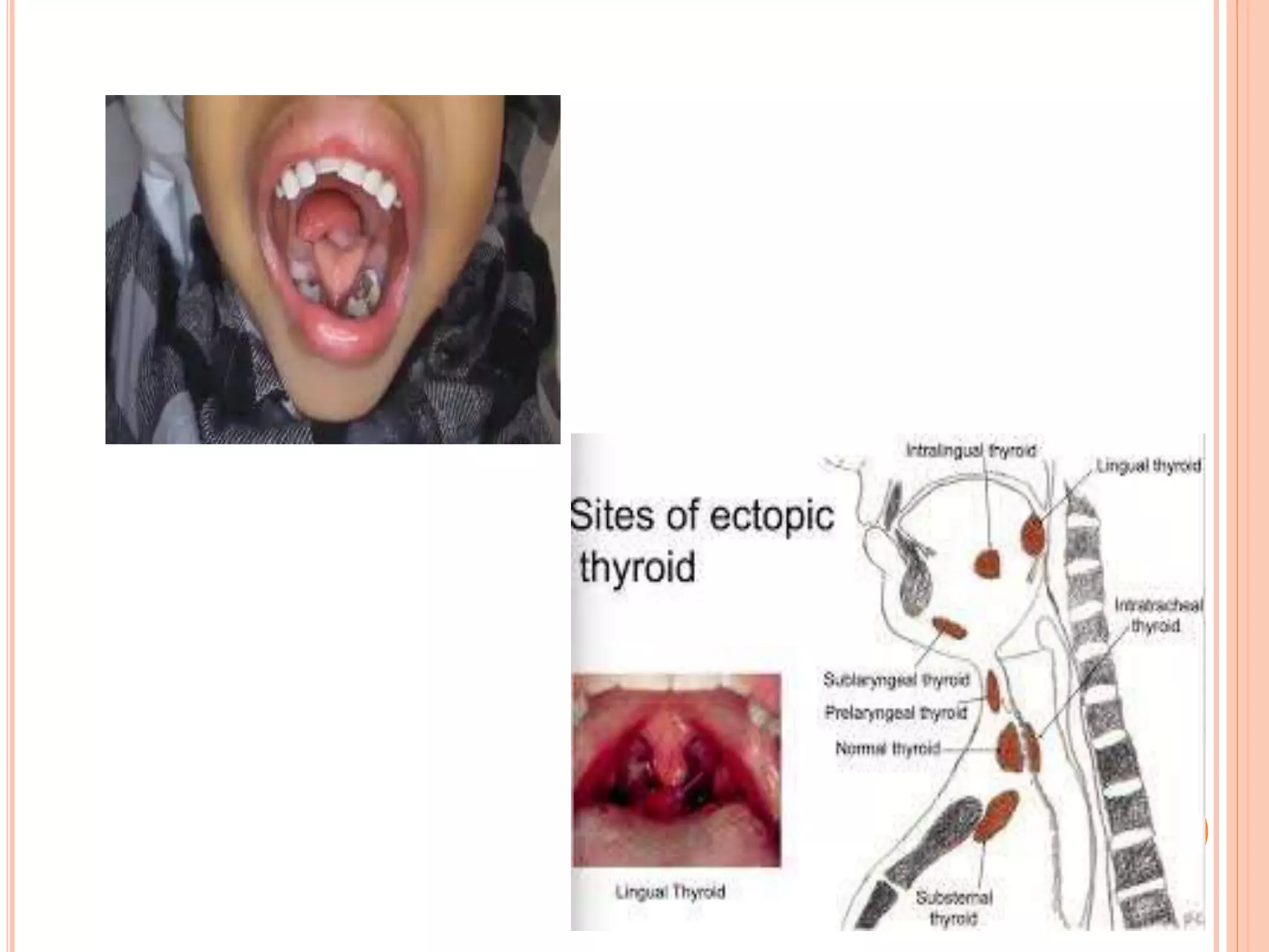 Development of tongue and thyroid gland | PPTX