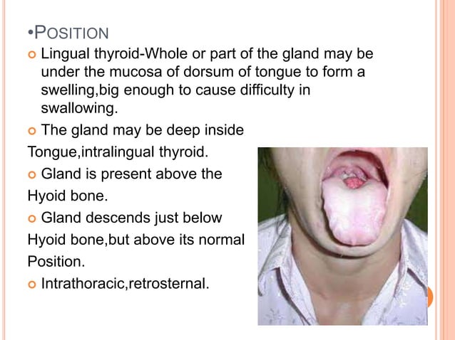 Development of tongue and thyroid gland | PPTX | Thyroid Disorders ...