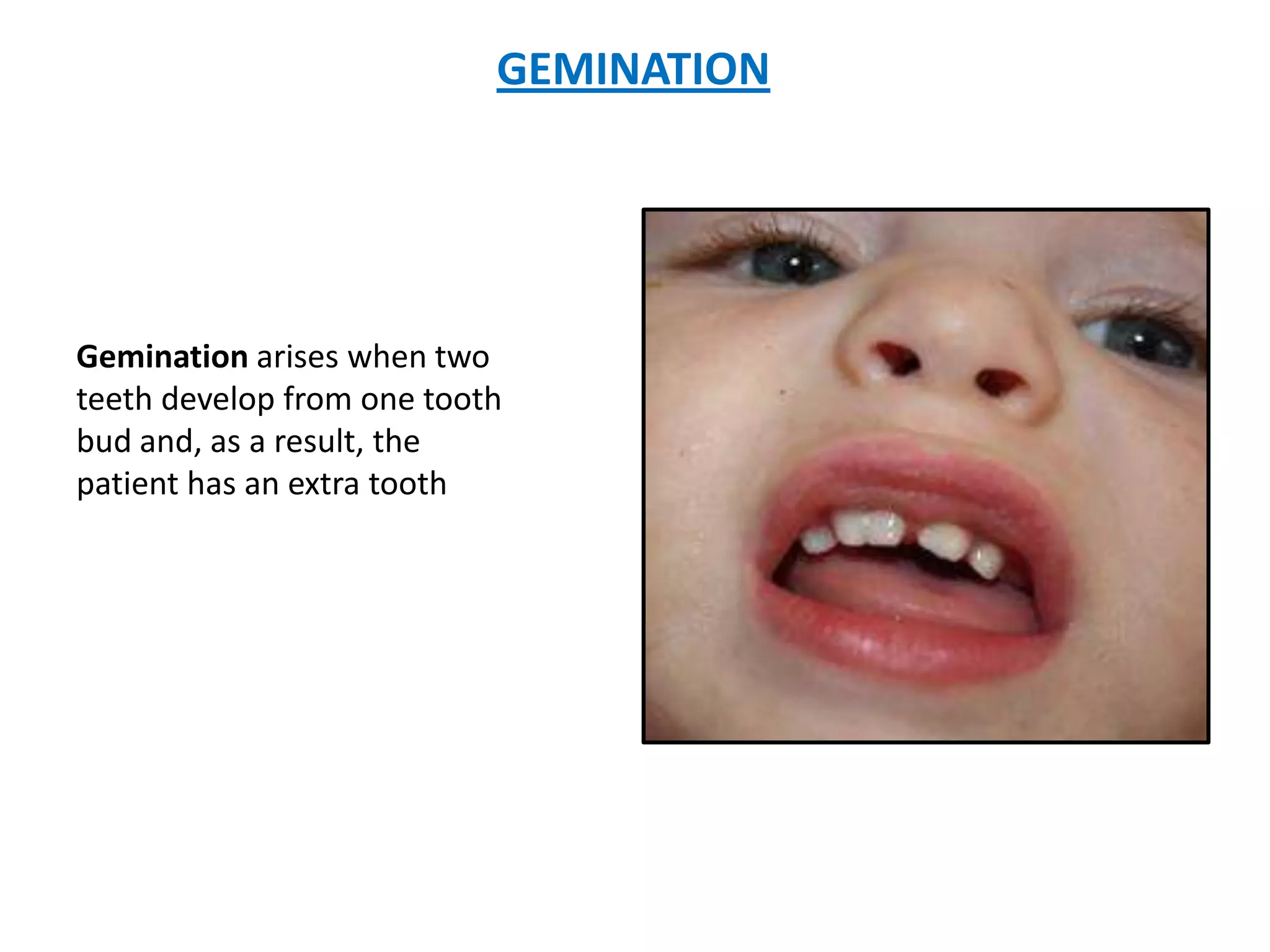 Development of tooth | PPTX
