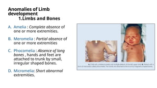Development of Upper Limb: clear, systematic overview of the ...
