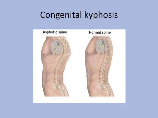 Development Of Vertebral Column