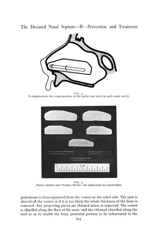 Deviated Nasal Septum | PDF