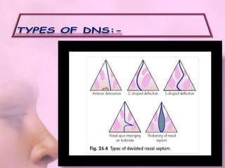 Deviated nasal septum | PPTX