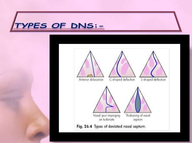 Deviated nasal septum | PPTX | Ear, Nose and Throat Conditions ...