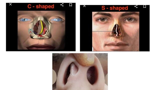 deviatednasalseptum | PPT