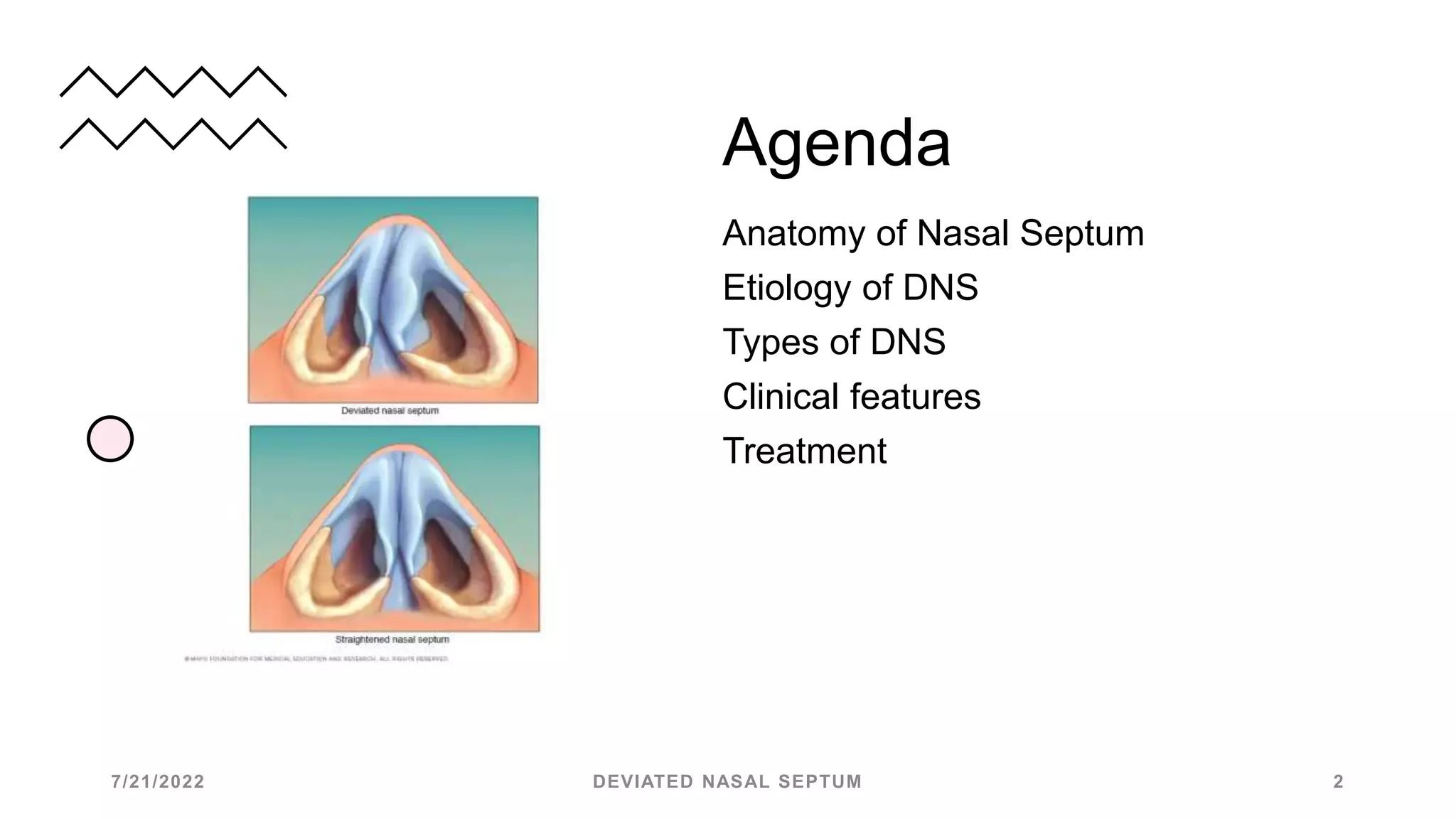 Deviated Nasal Septum.pptx