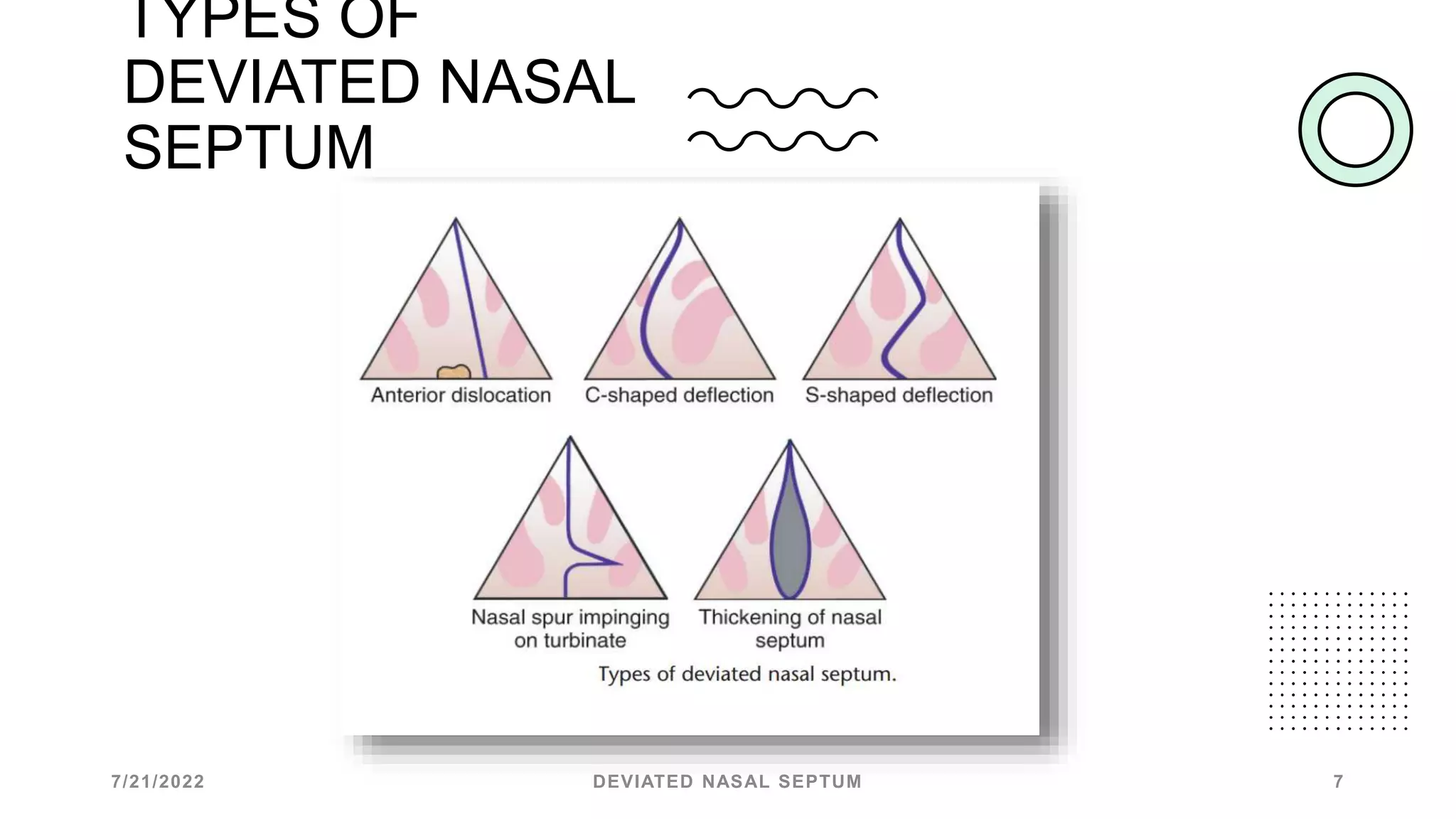 Deviated Nasal Septum.pptx