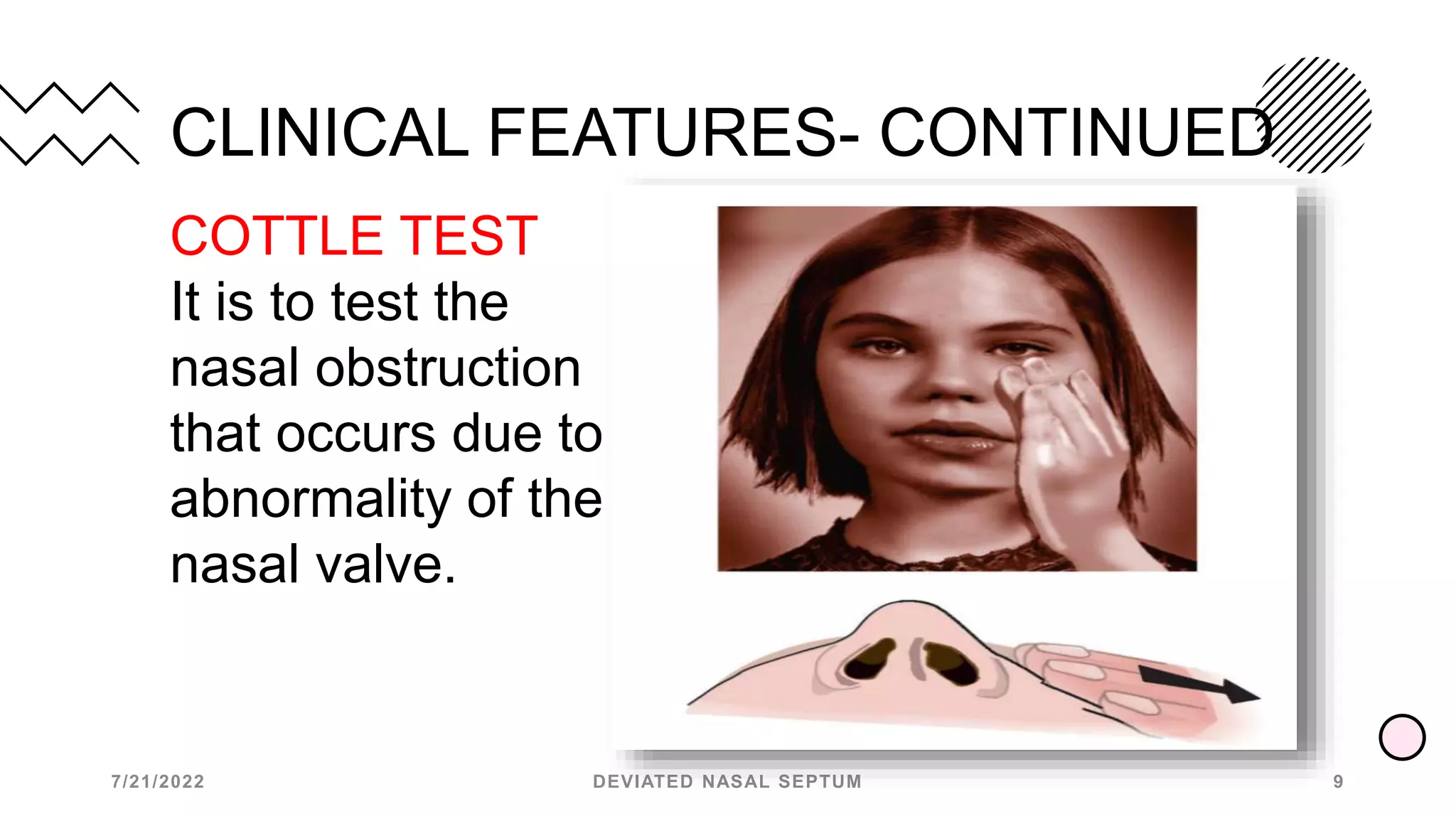 Deviated Nasal Septum.pptx