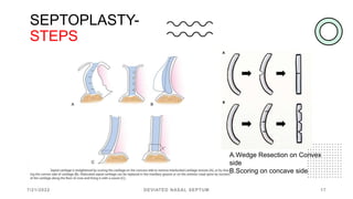 Deviated Nasal Septum.pptx