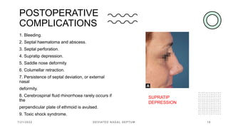 Deviated Nasal Septum.pptx