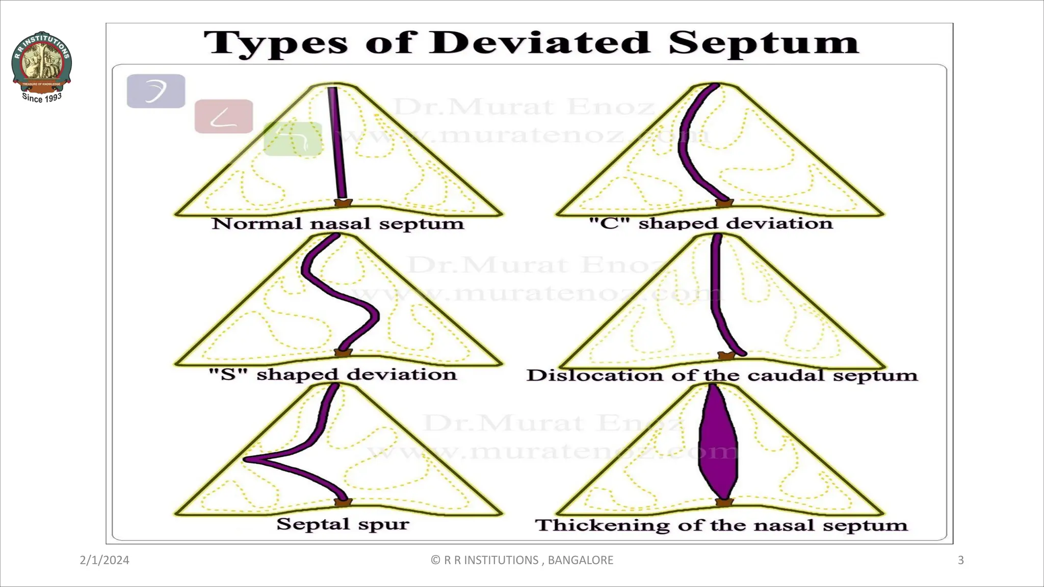 DEVIATED NASAL SEPTUM AND ITS MANAGEMENT.pdf