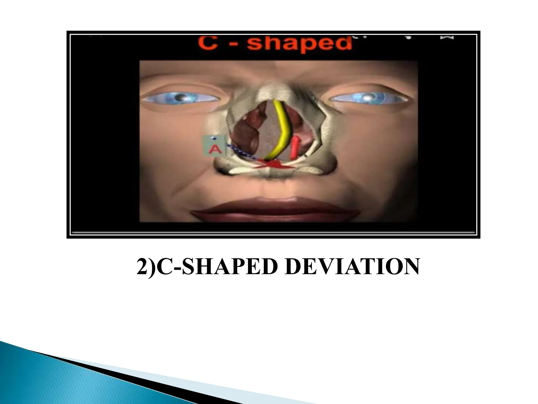 DEVIATED NASAL SEPTUM BY BHUMIKA.G.THAKOR | PPTX