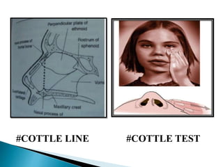 DEVIATED NASAL SEPTUM BY BHUMIKA.G.THAKOR | PPTX