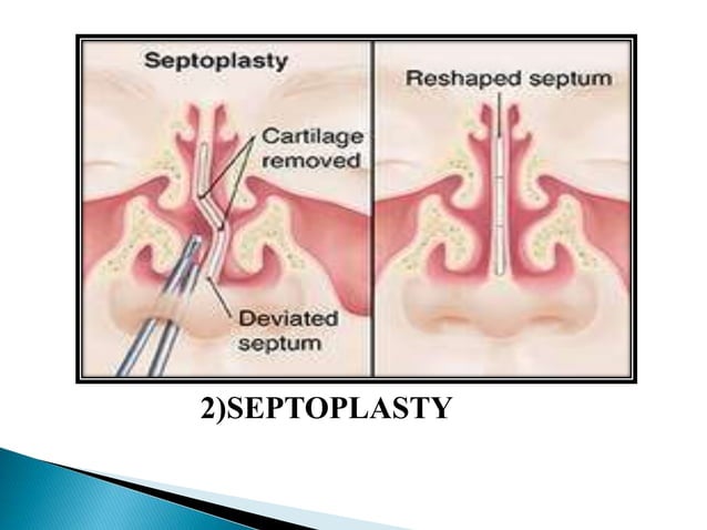 Deviated Nasal Septum By Bhumikagthakor Ppt Free Download