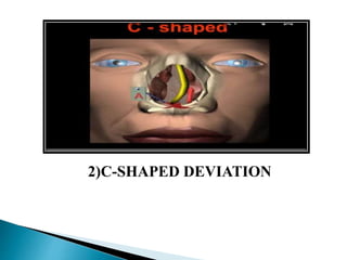 DEVIATED NASAL SEPTUM BY BHUMIKA.G.THAKOR | PPTX