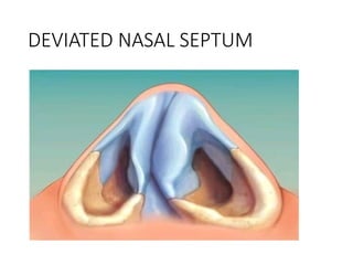 DEVIATED NASAL SEPTUM.in emergency carepptx | PPTX