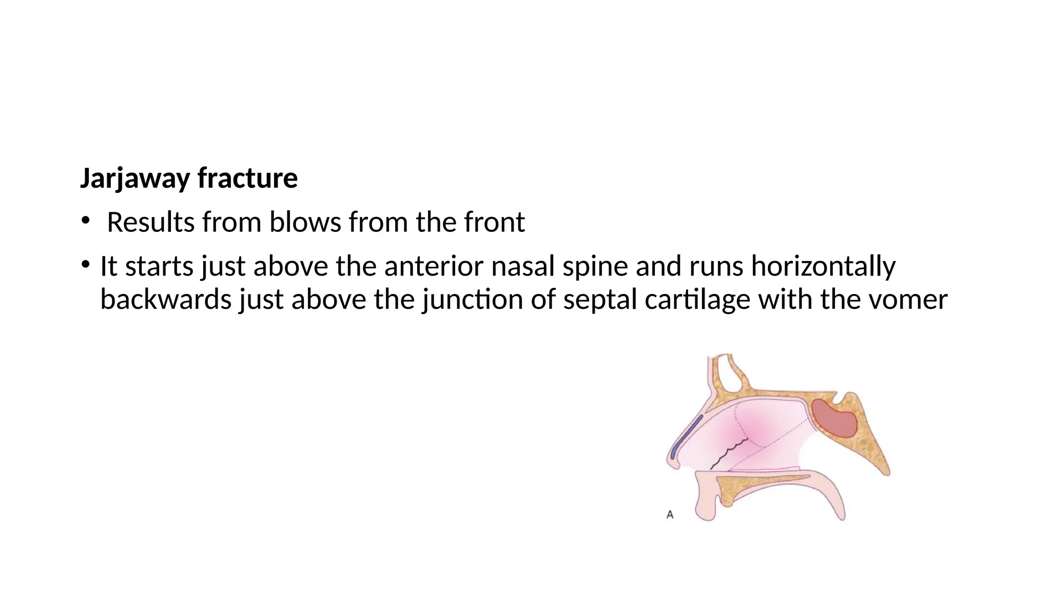Deviated Nasal Septum DNS ENT Topic.pptx